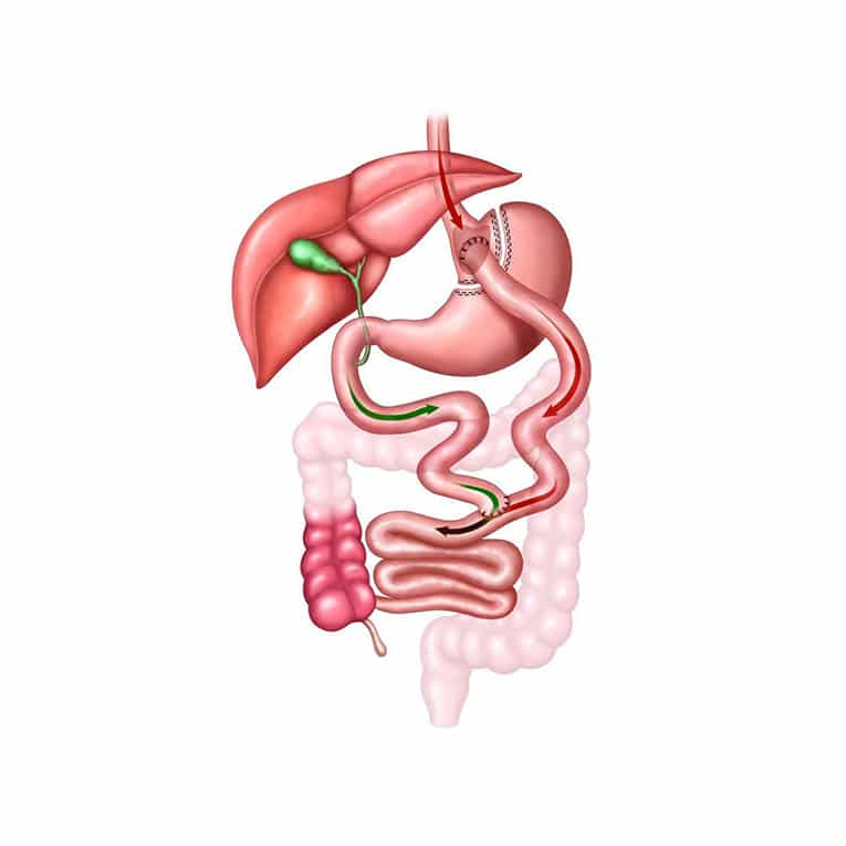 »Bypass Gastroileal - Tratamiento | Obymed